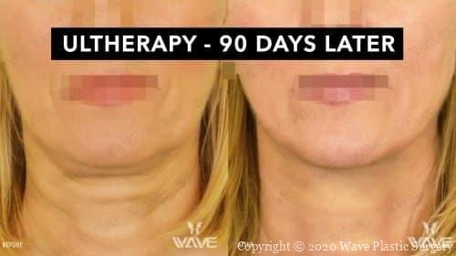 Wave Answers Your Top 10 Ultherapy Questions | Wave Plastic Surgery