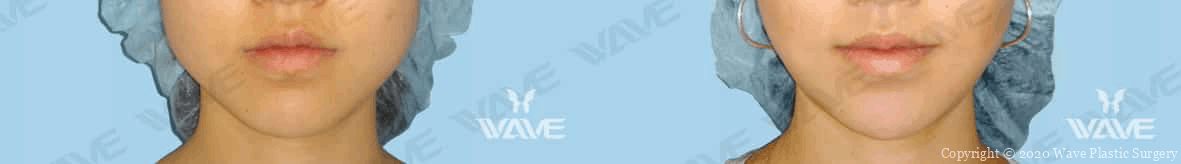 Jaw Reduction Surgery in Los Angeles | Wave Plastic Surgery