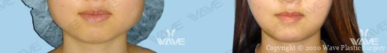 Jaw Reduction Surgery in Los Angeles | Wave Plastic Surgery