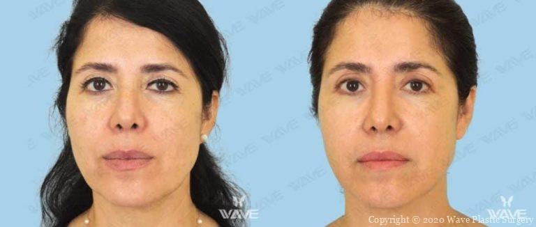 Ultherapy vs. Thermage: Which Treatment is Better? | WAVE