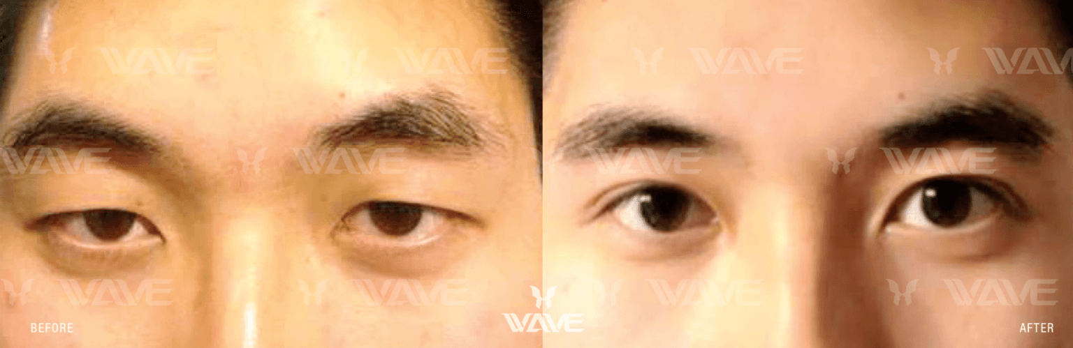 Surgery To Make Eyes Bigger | Wave Plastic Surgery