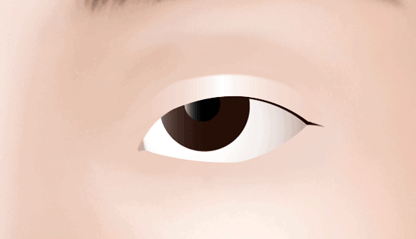 Surgery To Make Eyes Bigger | Wave Plastic Surgery