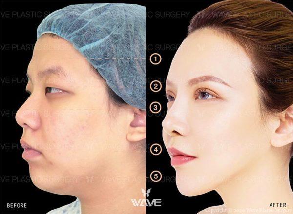 Before and After Photo Gallery | Wave Plastic Surgery
