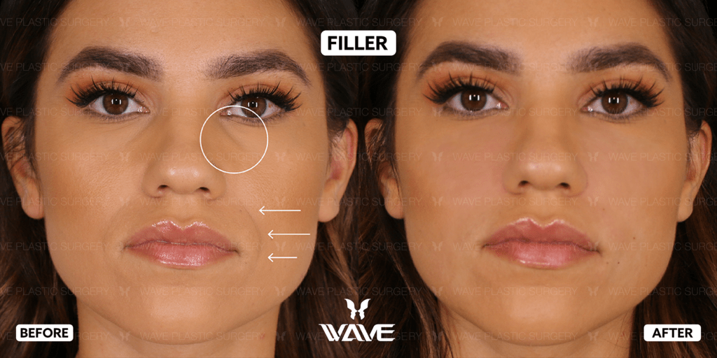 Wave Models Program | Wave Plastic Surgery