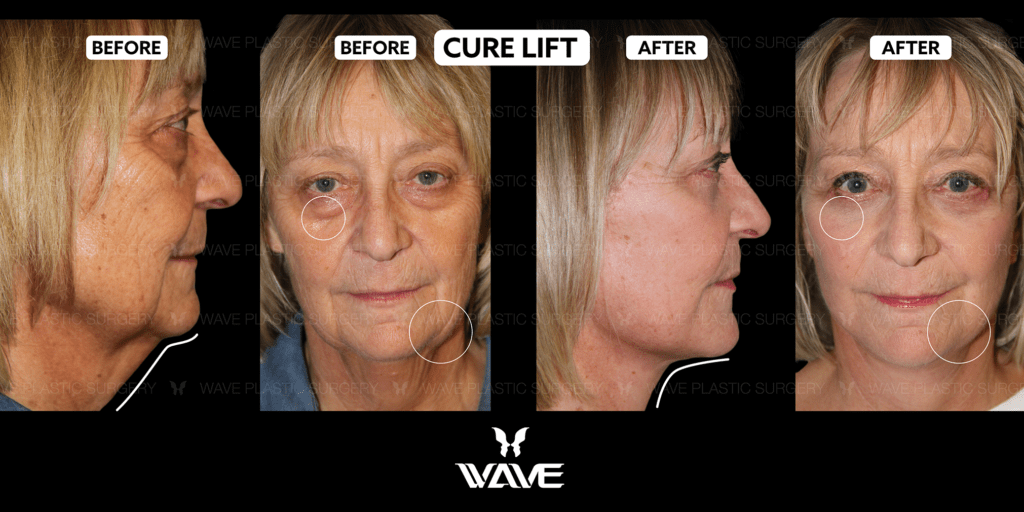 Wave Models Program | Wave Plastic Surgery