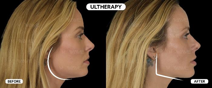 Ultherapy vs Thermage: Which Skin Tightening Treatment is Best?
